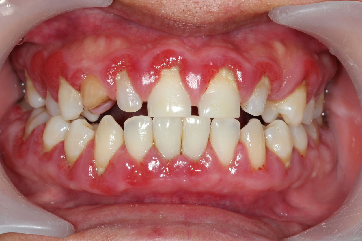 Early Periodontitis Can Be Reversed